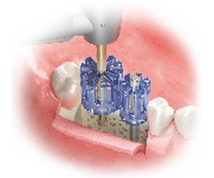 OSSTEM Paralell -Guide System - ImplAg-Shop