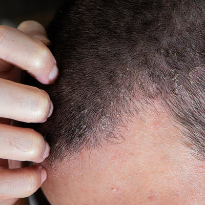 Huidaandoeningen - Dermatologie-winkel.nl