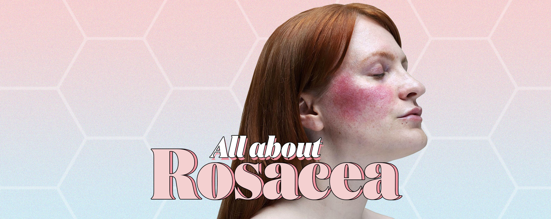 What is Rosacea - Little Wonderland
