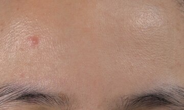 Beste tips voor acne verzorgen bij een vette huid - Viva Donna