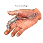 Triggerfinger | Vingerspalk kopen? - ProBrace