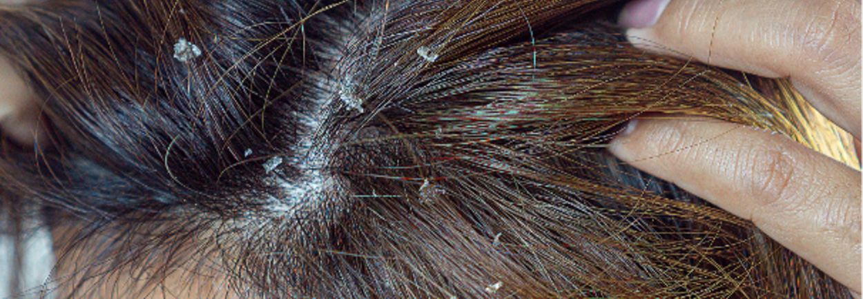 Hoofdhuidproblemen: dit zijn de oorzaken en zo kom je ervan af ...