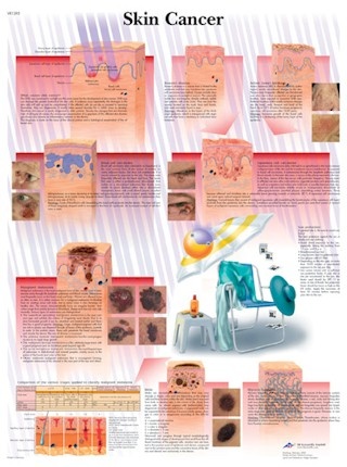 Anatomie Poster Skin cancer / Huidkanker - Vosmedisch.nl - A. Vos en ...