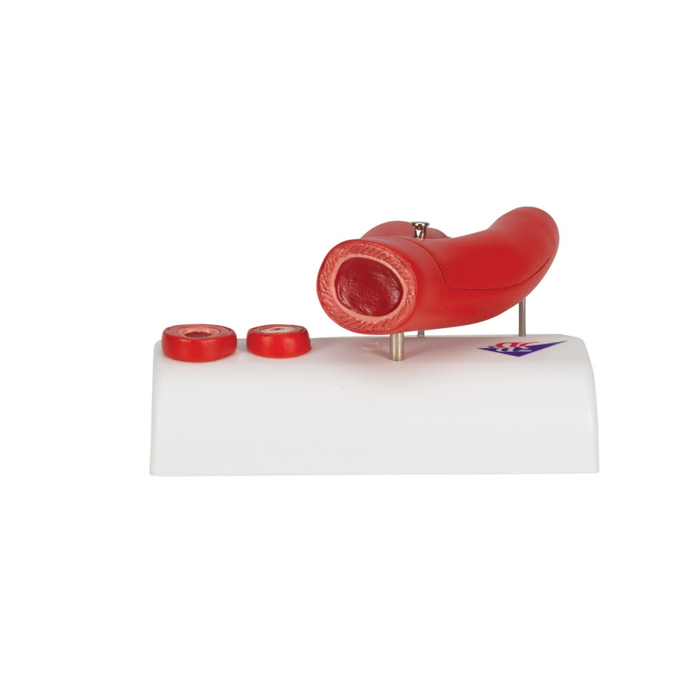 Aderverkalkingsmodel + doorsnede van de slagader - Vosmedisch.nl