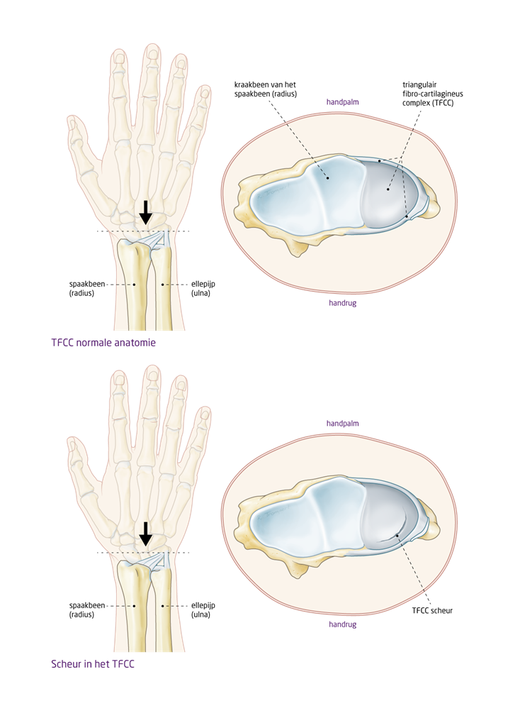 TFCC Brace Pro Orthic - Vosmedisch.nl - A. Vos en Zoons B.V.