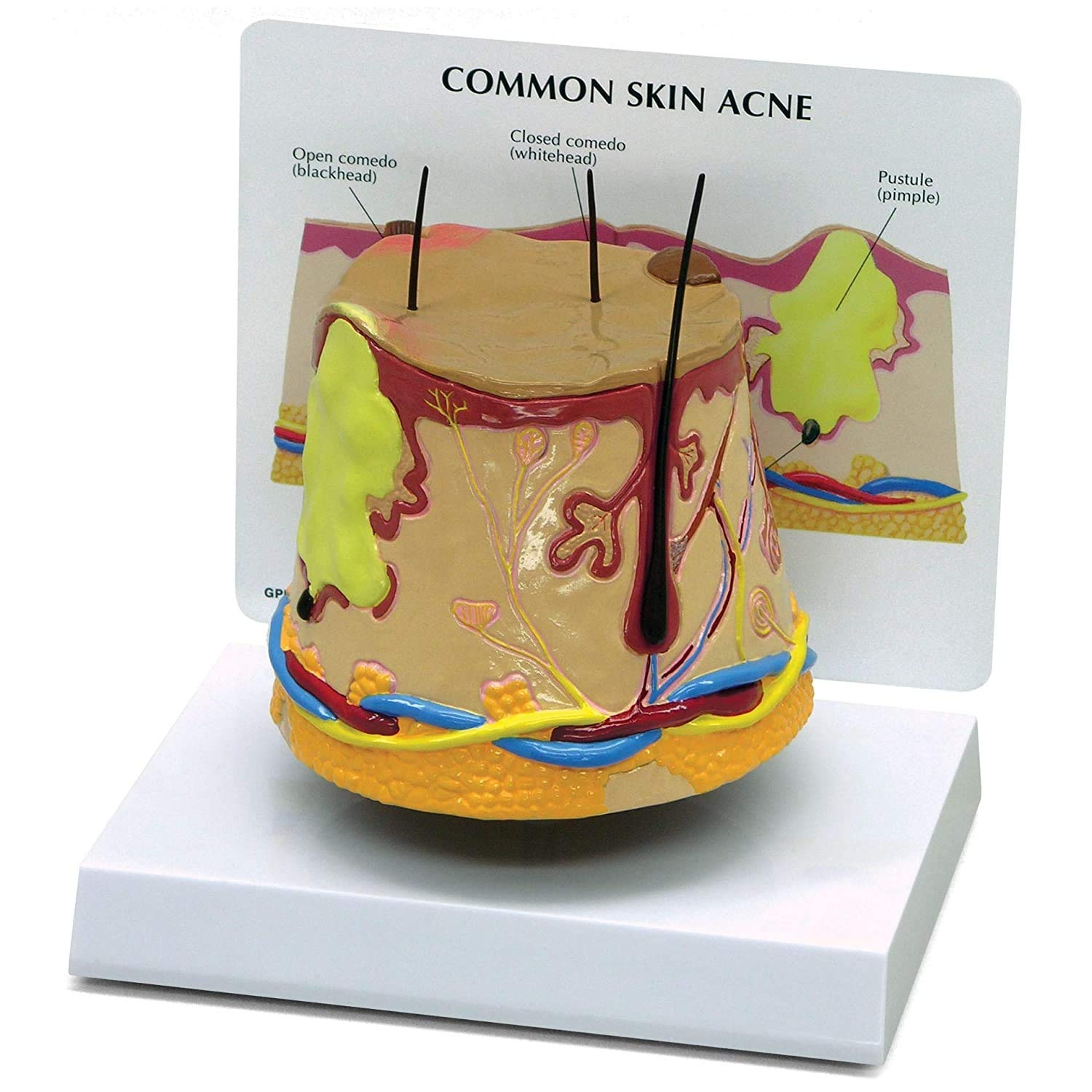 Anatomisch model van de huid met Acne - Vosmedisch.nl - A. Vos en Zoons ...