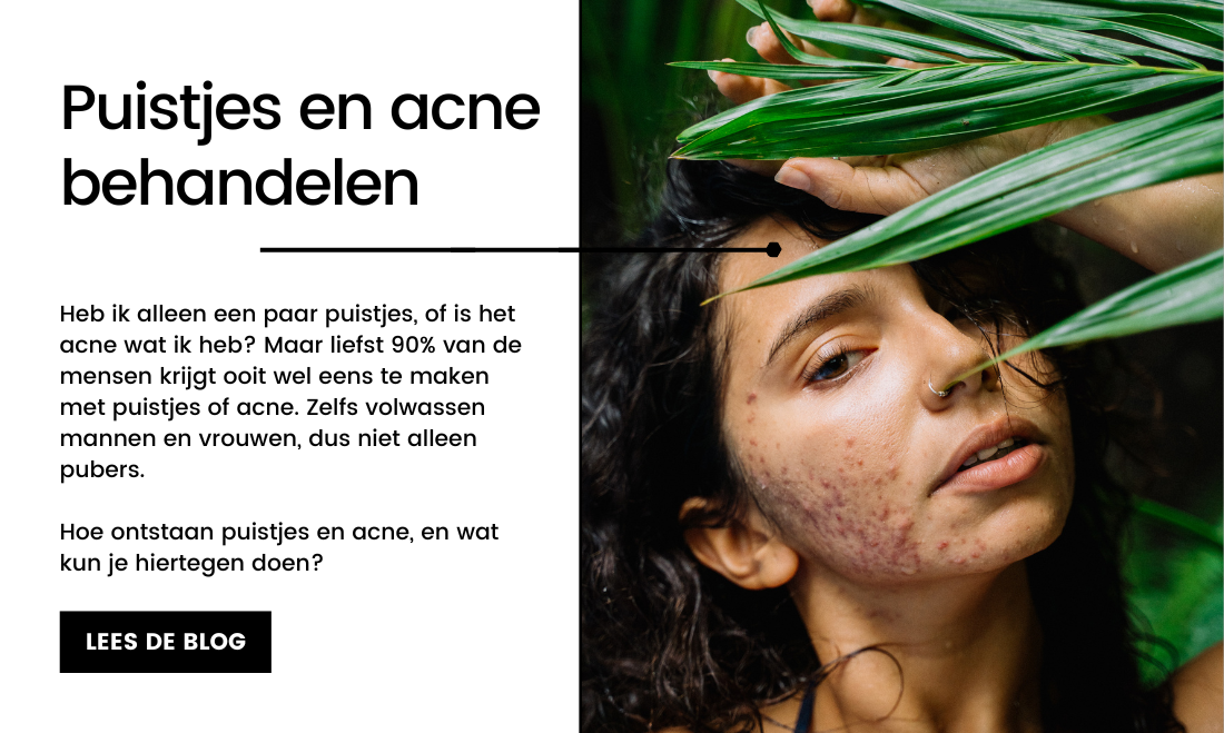 Puistjes en acne behandelen - Care for Skin