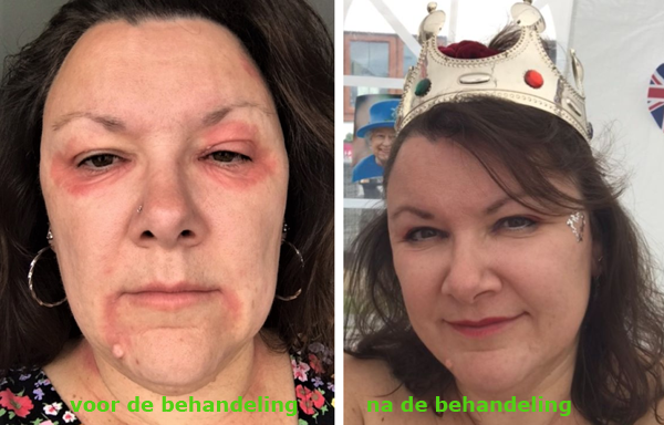 Ooggel voor de droge huid rond de ogen | Eczeem ooggel | Blefaritis - Nisim