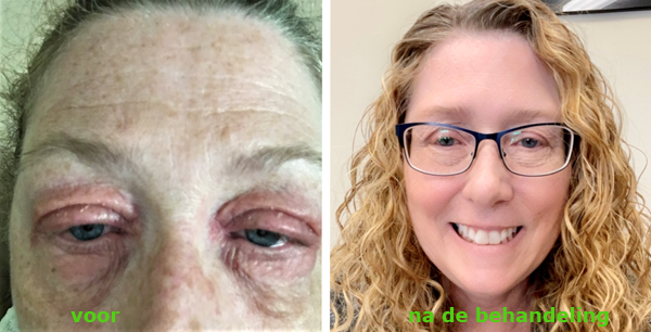 Ooggel voor de droge huid rond de ogen | Eczeem ooggel | Blefaritis - Nisim