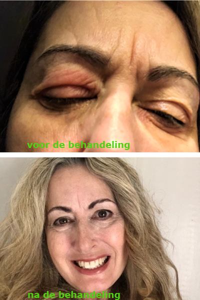 Ooggel voor de droge huid rond de ogen | Eczeem ooggel | Blefaritis - Nisim